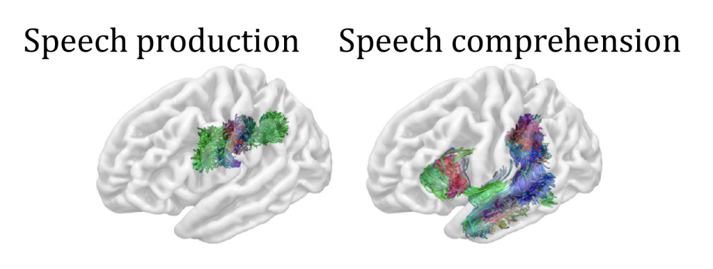 The Anatomy of Aphasia Revisited | C-STAR