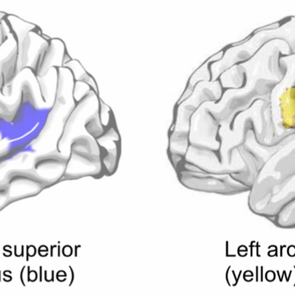 Predicting Aphasia Recovery: The Role of Brain Damage and SSRI Use | C-STAR